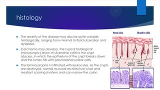 Ulcerative colitis | PPTX