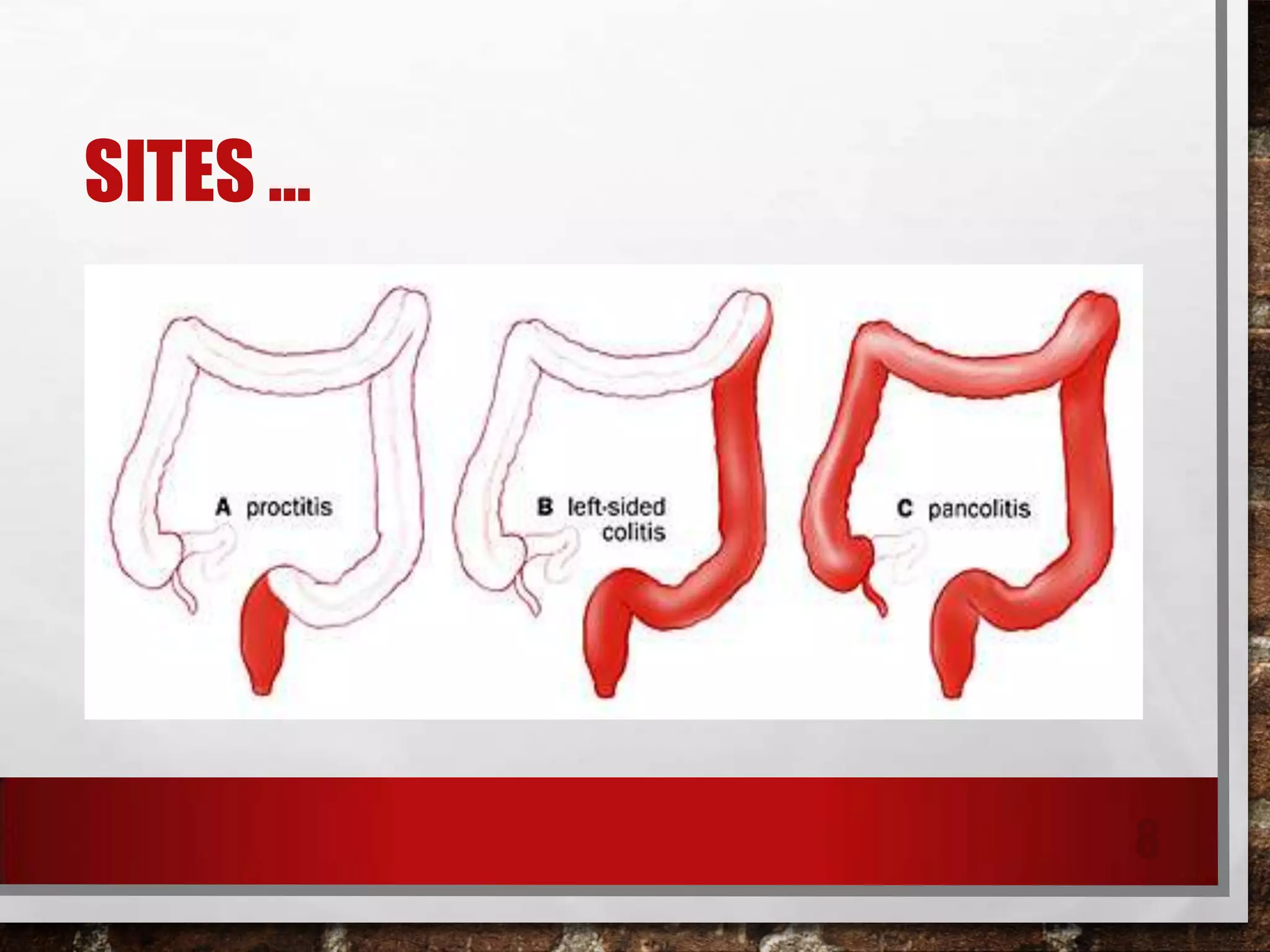 Ulcerative colitis | PPT