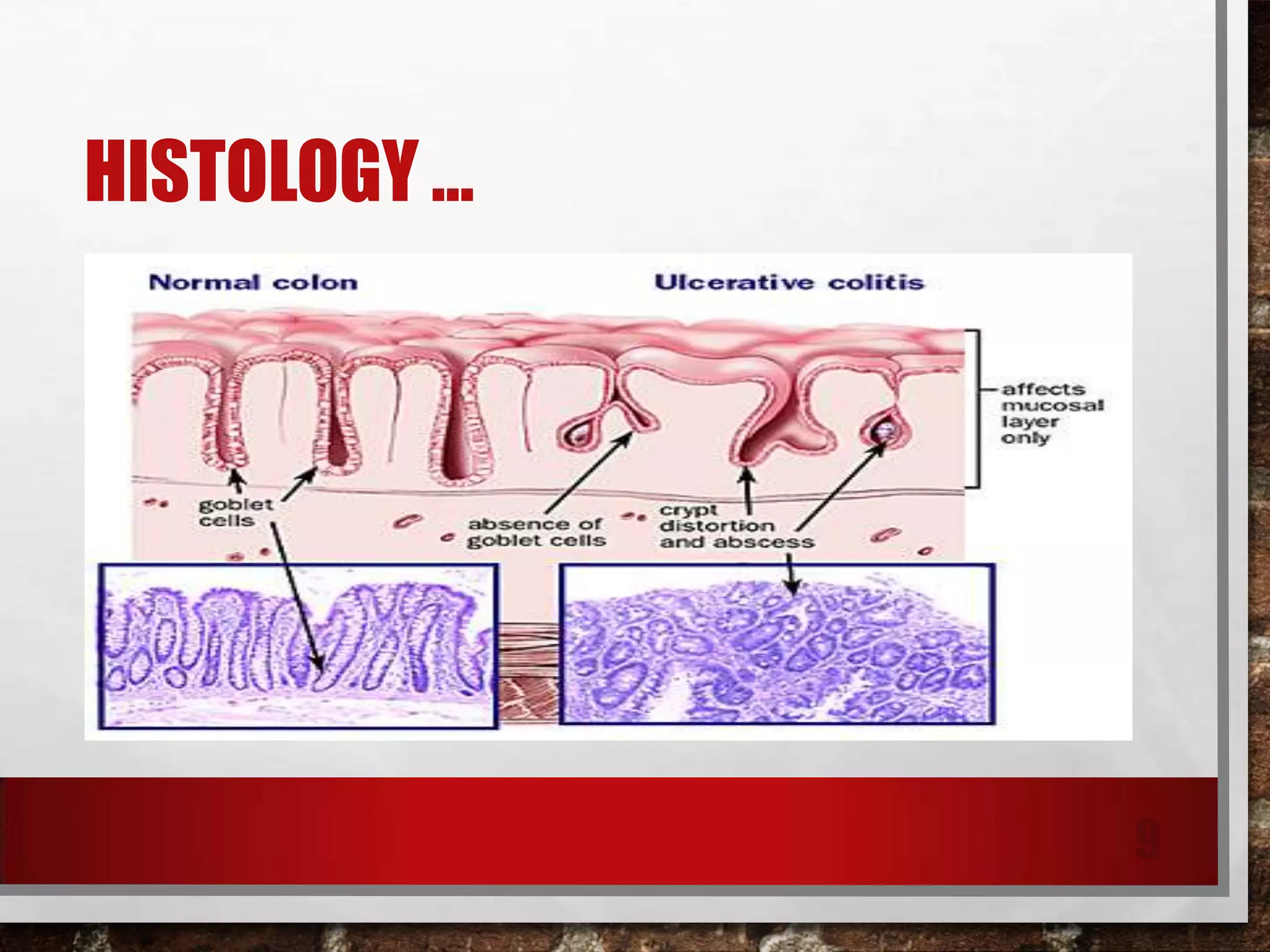 Ulcerative colitis | PPT