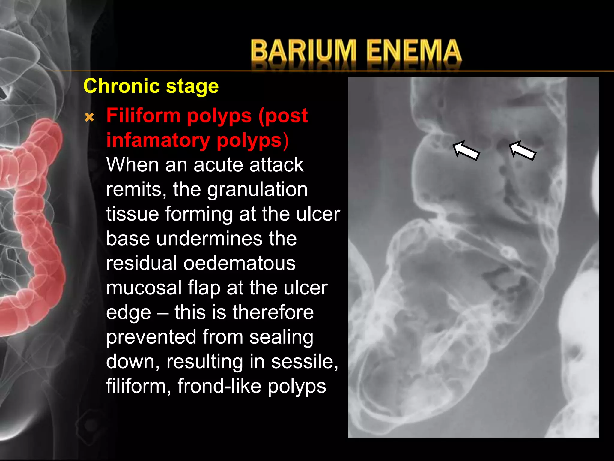 Ulcerative Colitis | PPTX