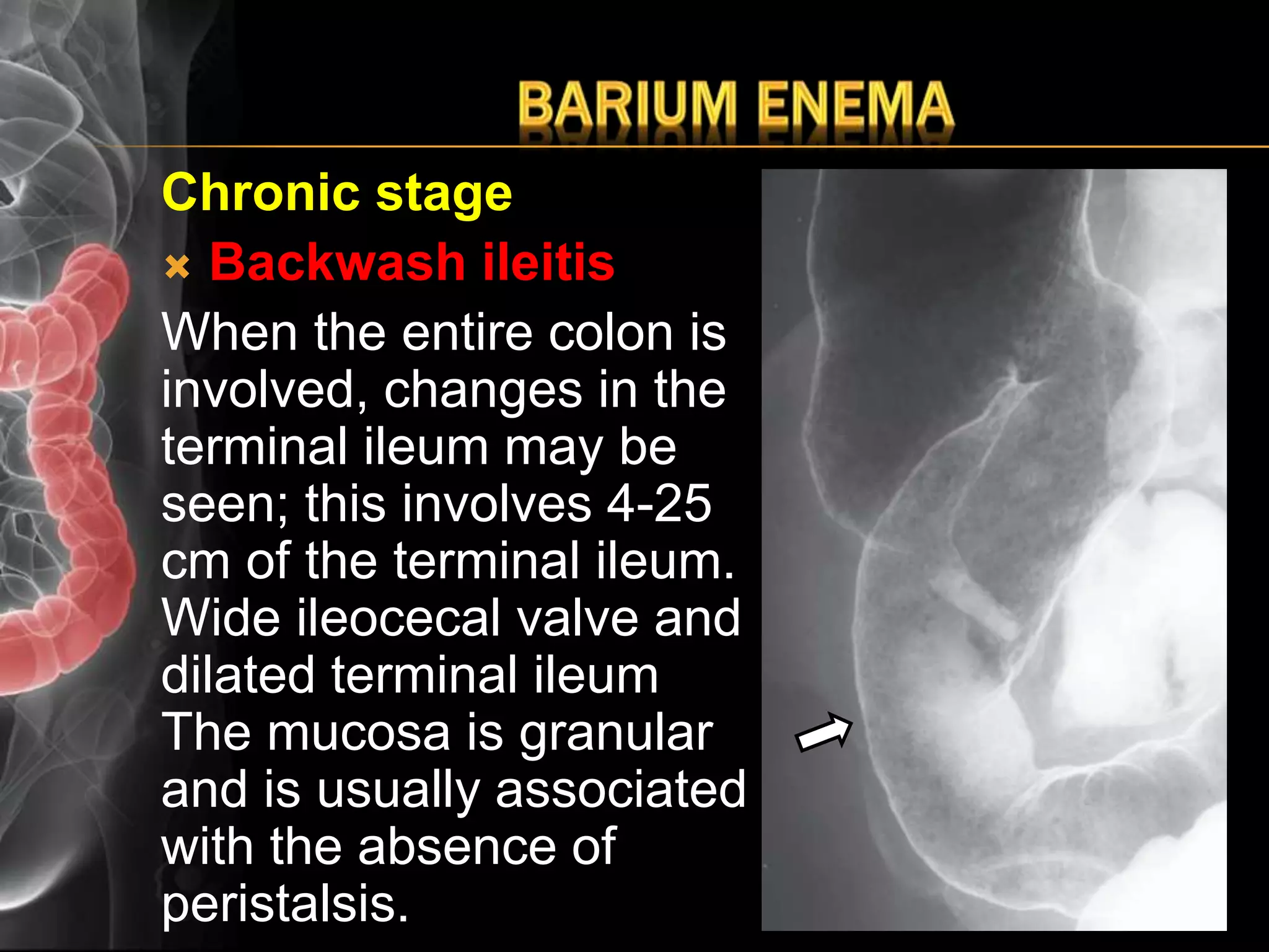 Ulcerative Colitis | PPTX