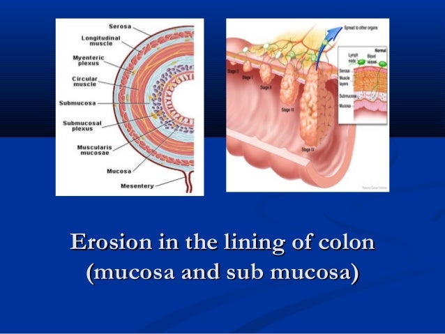 Colon Erosion