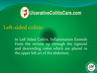 Ulcerative colitis | PPT