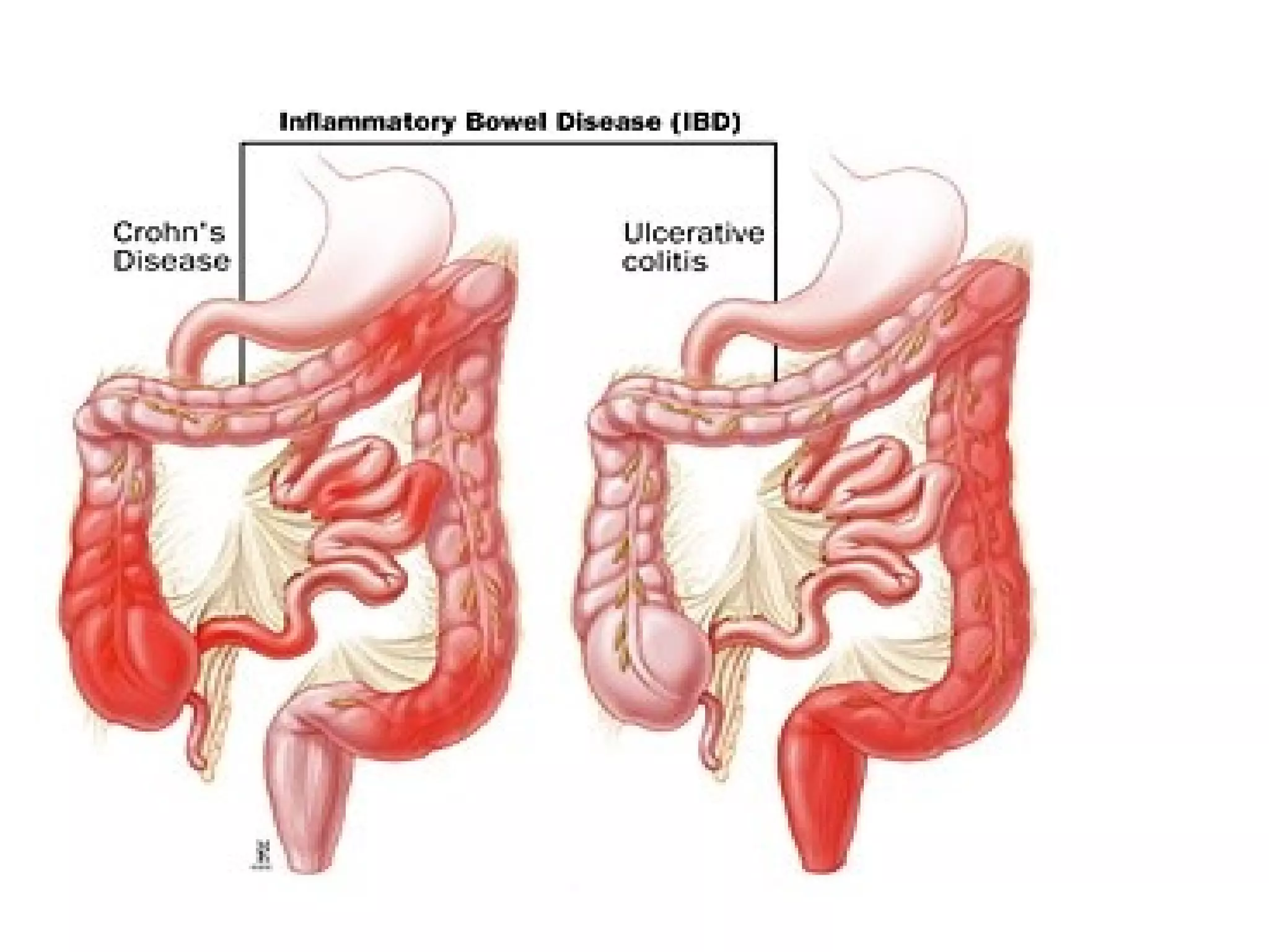 Ulcerative colitis | PPT