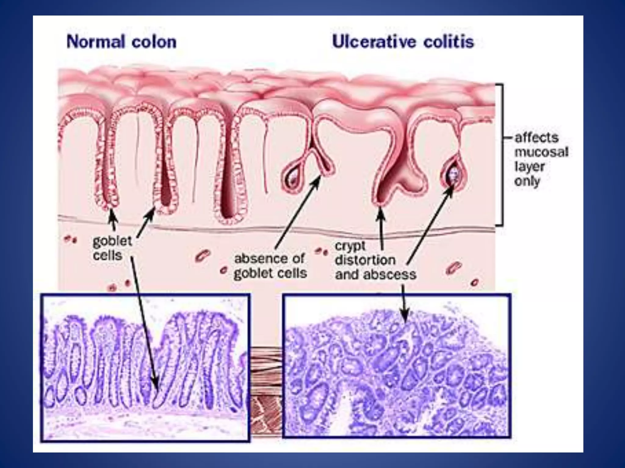 Ulcerative colitis | PPTX