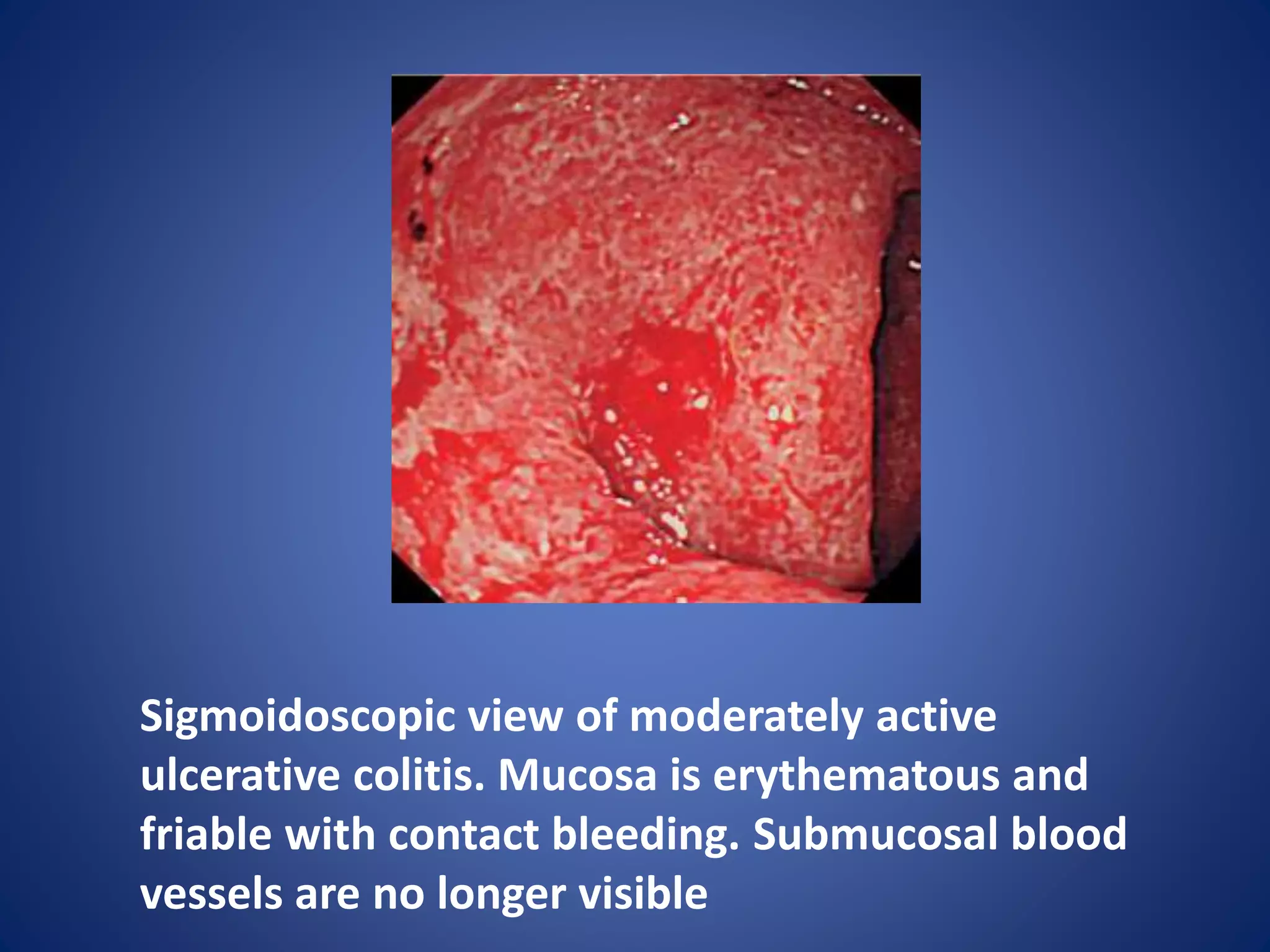 Ulcerative colitis | PPTX