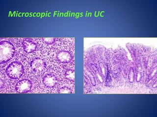 Ulcerative colitis | PPTX