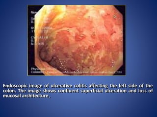 Ulcerative colitis | PPTX
