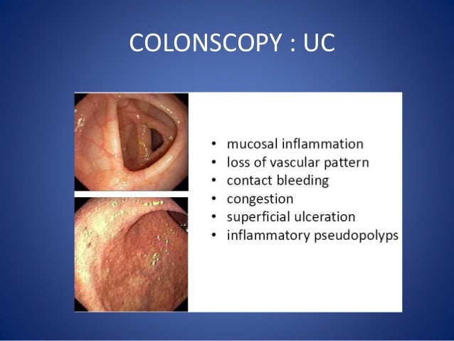 Ulcerative colitis