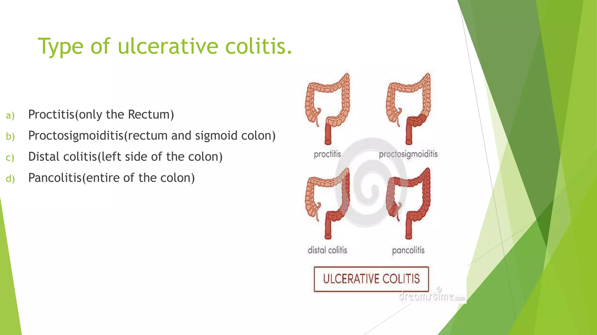 Ulcerative colitis | PPTX