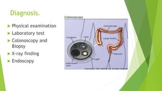 Ulcerative colitis | PPTX