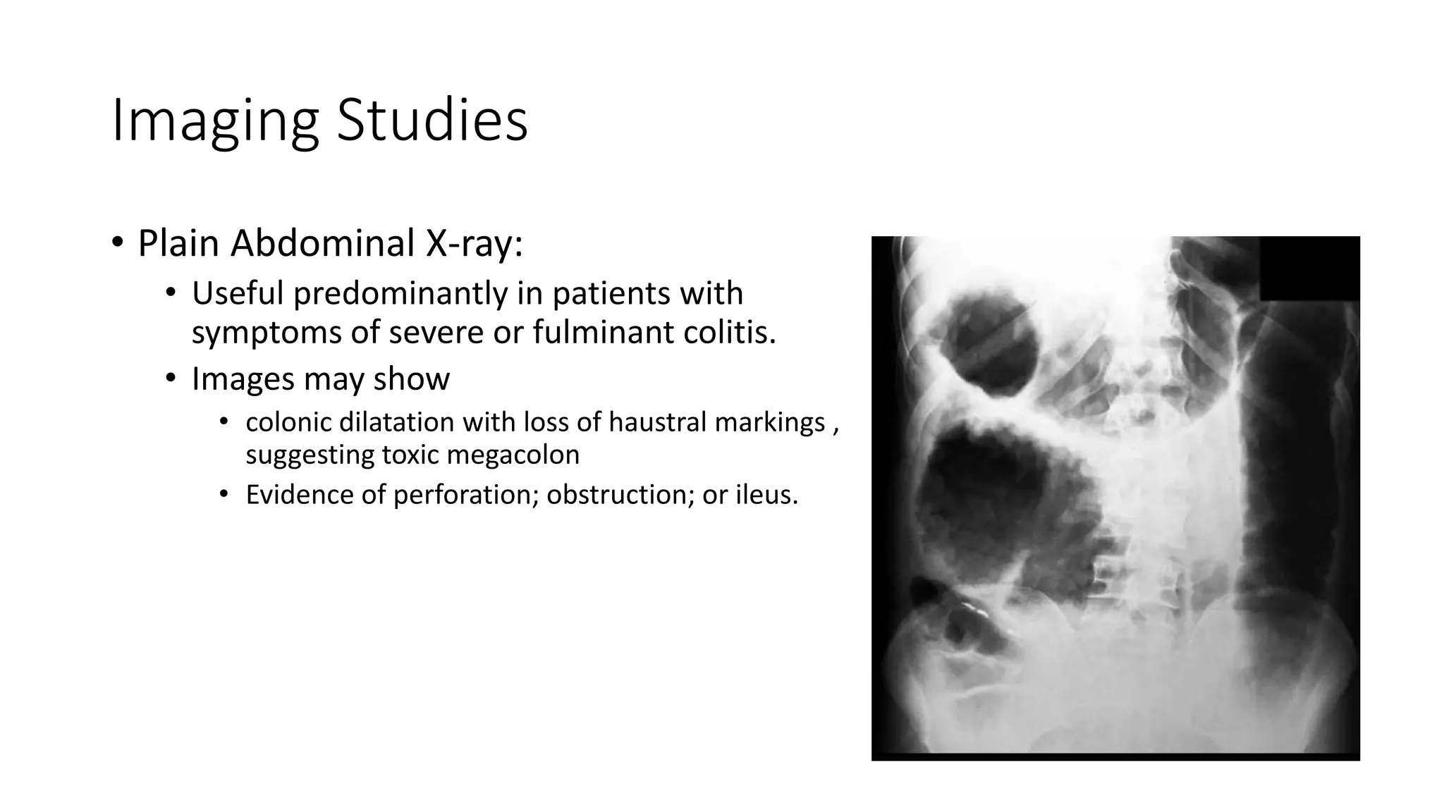 Ulcerative colitis | PPTX