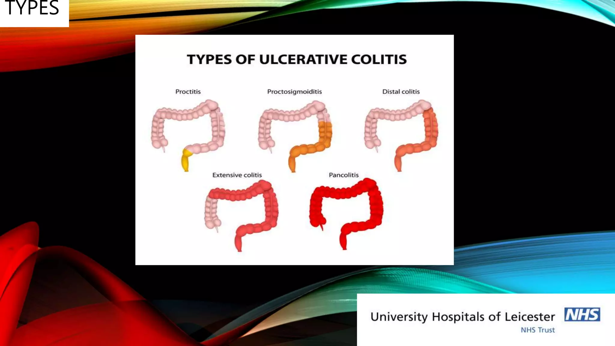 Ulcerative colitis | PPTX