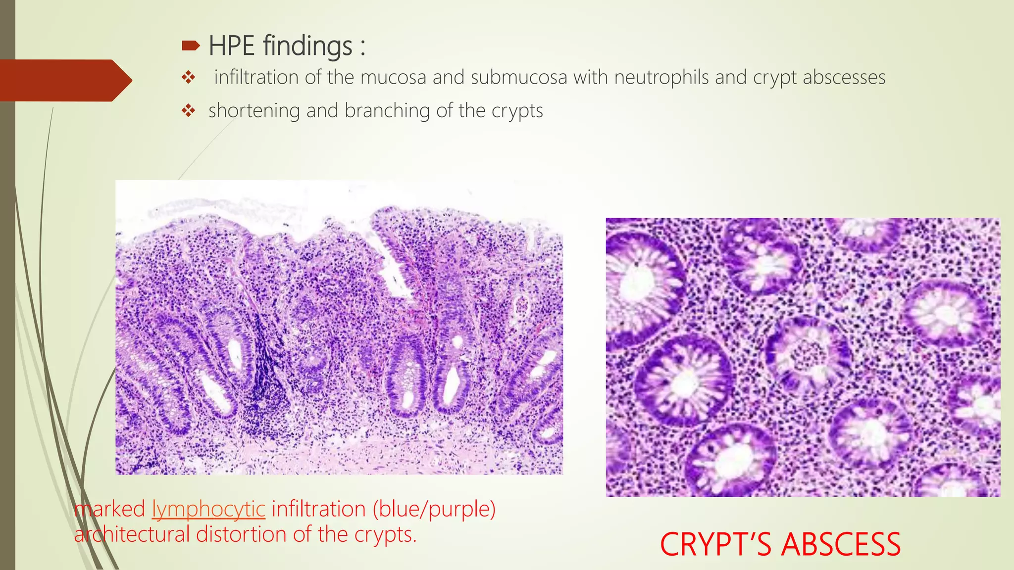 Ulcerative colitis | PPTX