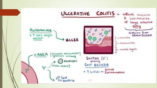 Ulcerative colitis | PPTX