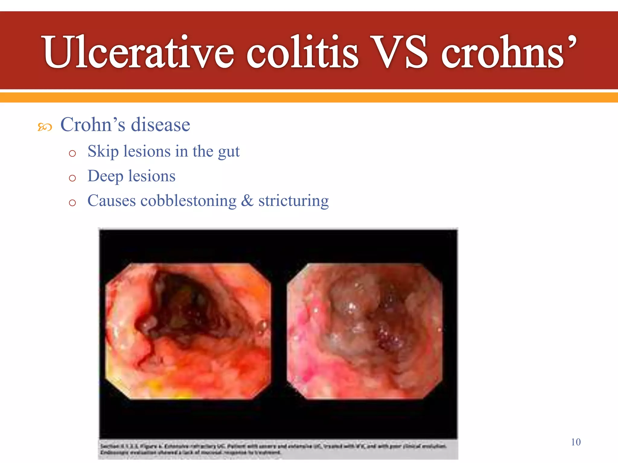 Ulcerative Colitis: Case Presentation & Disease Overview | PPTX