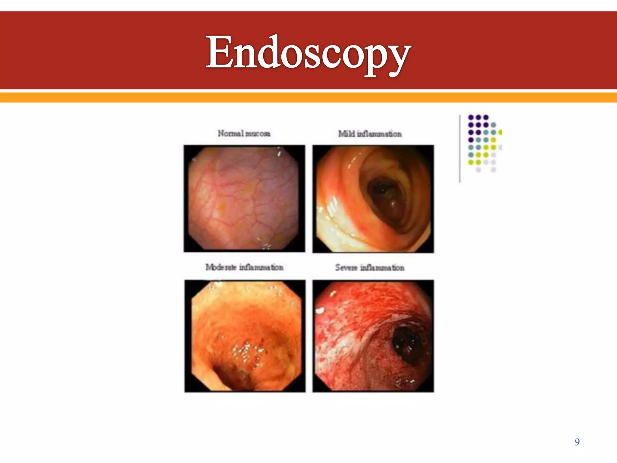 Ulcerative Colitis: Case Presentation & Disease Overview | PPTX