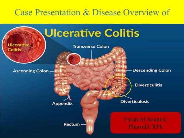 Ulcerative Colitis: Case Presentation & Disease Overview | PPTX | Digestive Disorders | Diseases ...