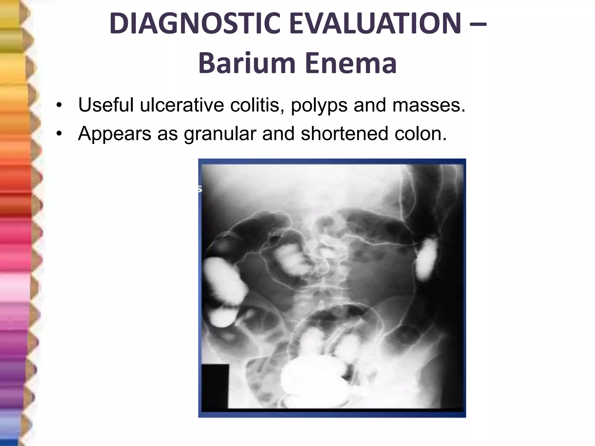 ULCERATIVE COLITIS | PPTX