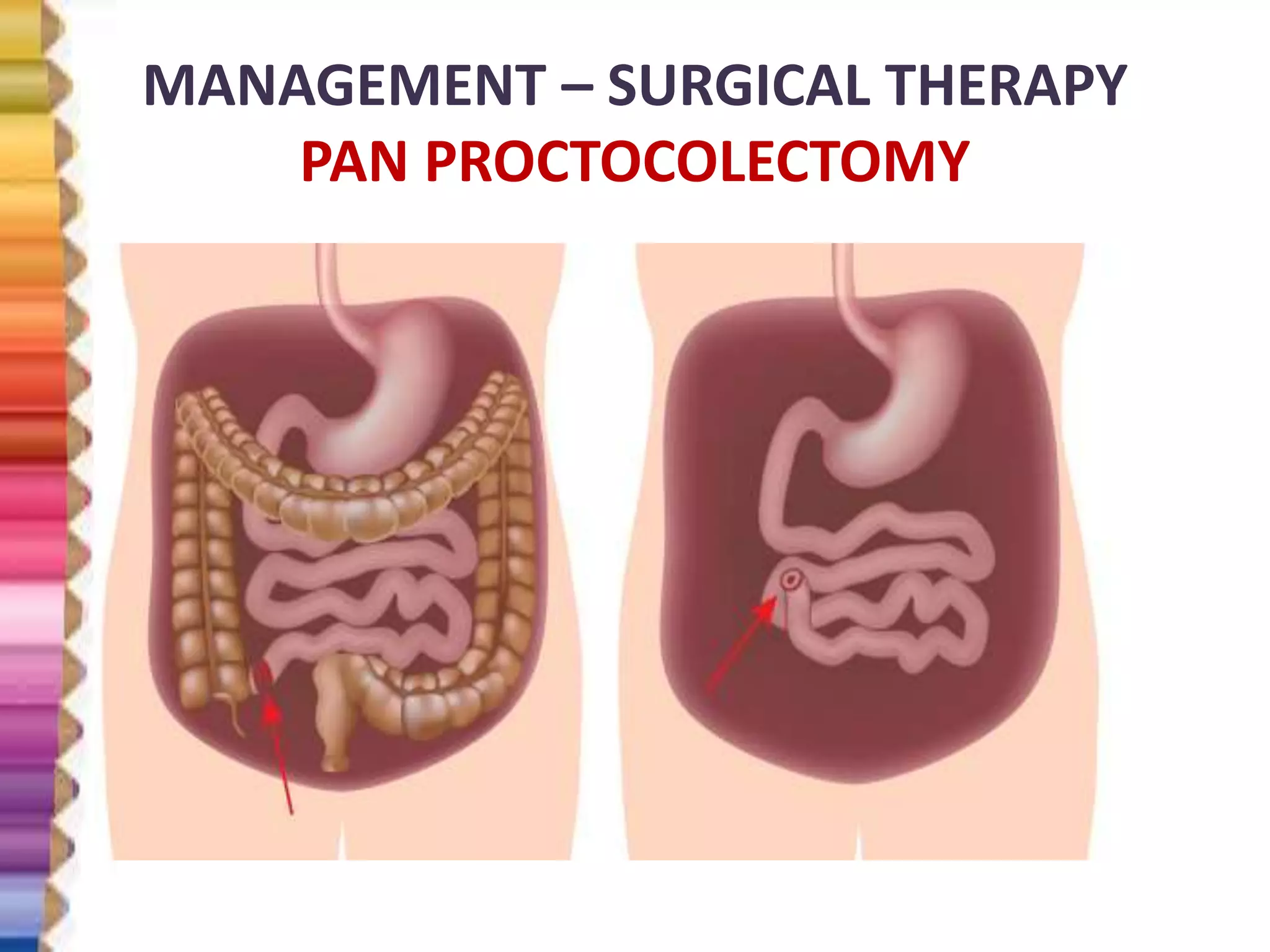 ULCERATIVE COLITIS | PPTX