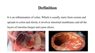 Ulcerative Colitis.pptx