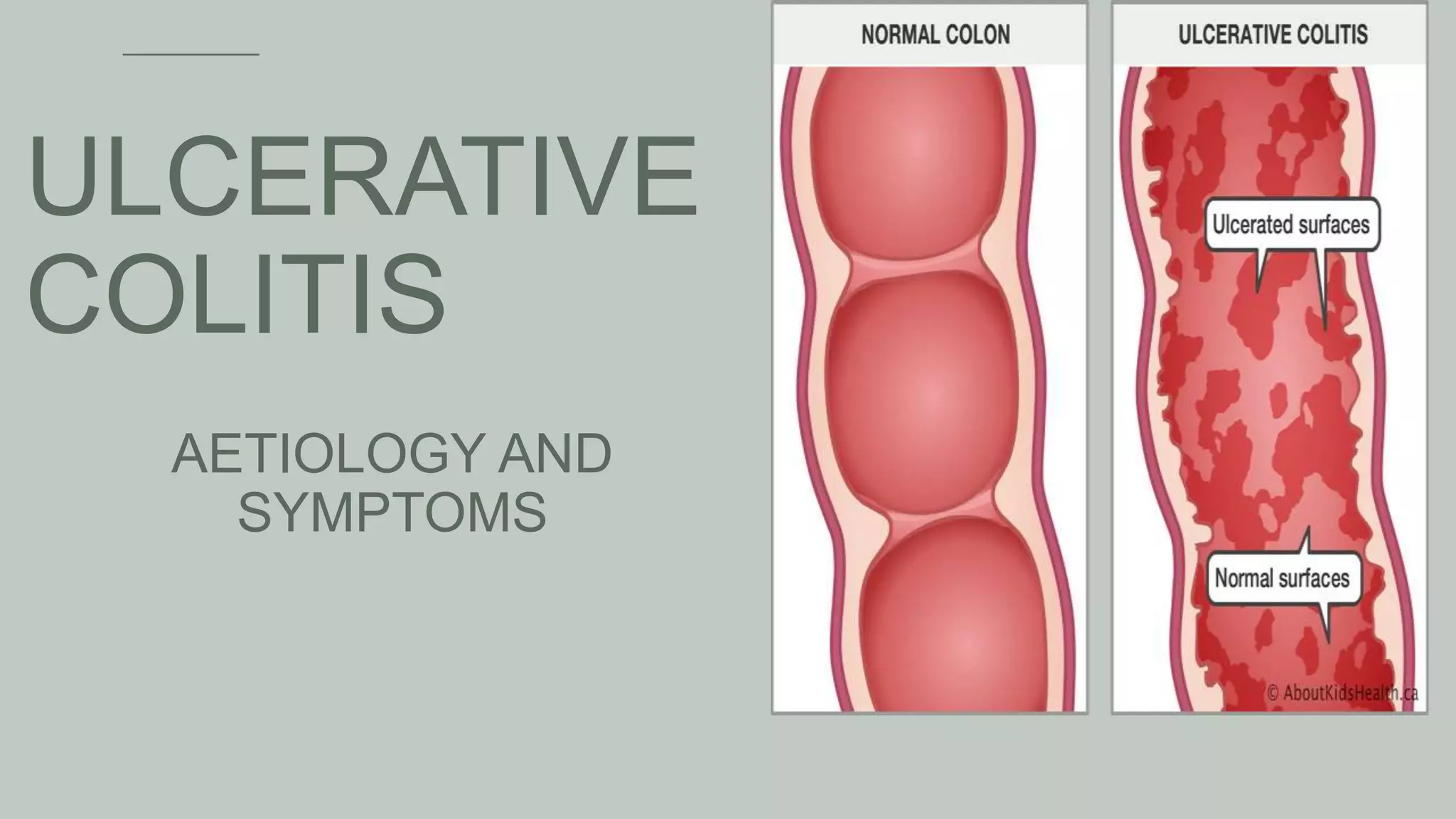 ULCERATIVE COLITIS.pptx