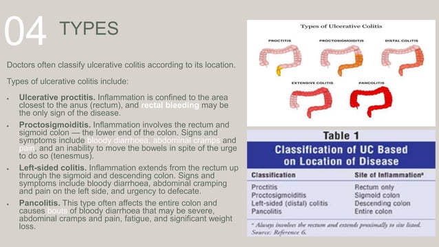 ULCERATIVE COLITIS.pptx