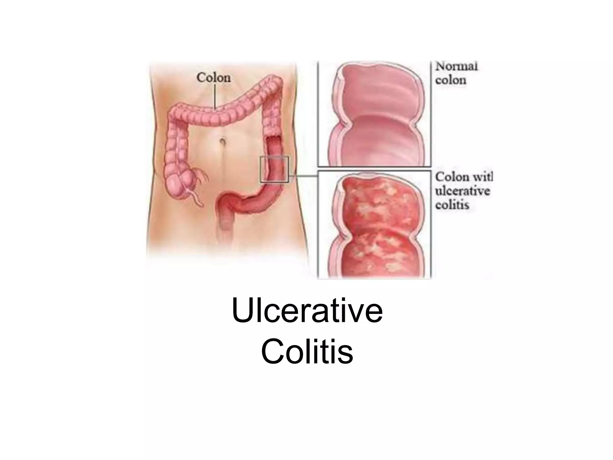 ulcerative colitis.pptx
