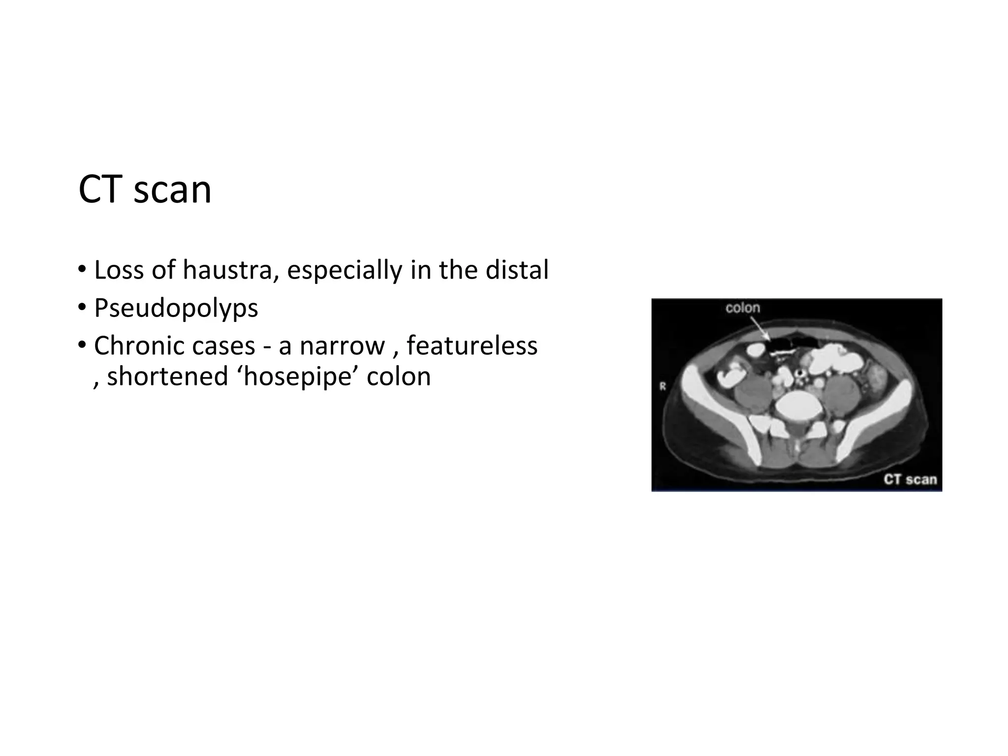 ulcerative colitis.pptx