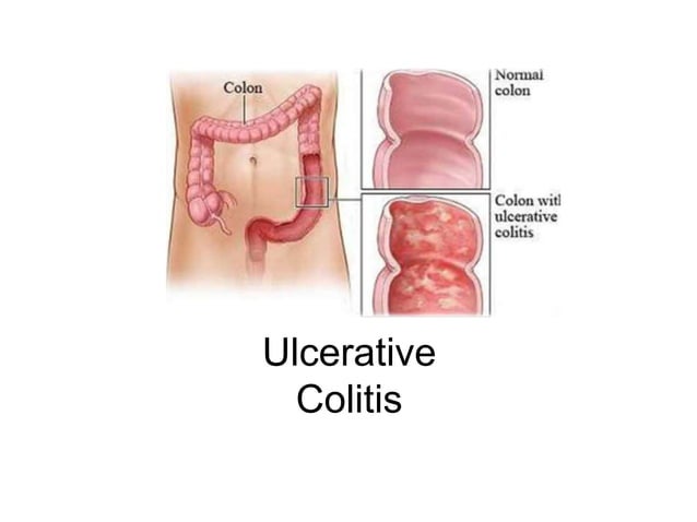 ulcerative colitis.pptx