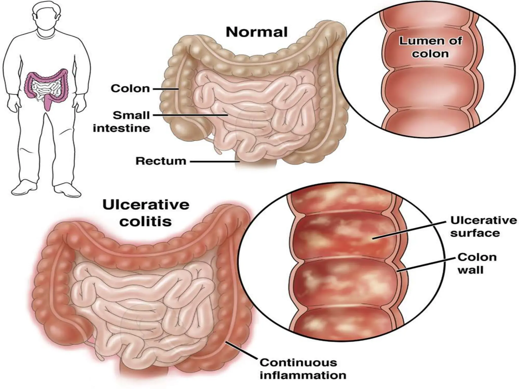Ulcerative Colitis.pptx