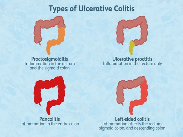 Ulcerative Colitis.pptx