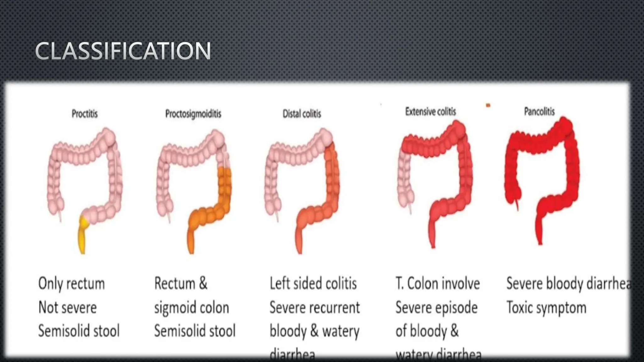 Ulcerative colitis (inflammatory Bowel Disease) | PPTX | Digestive ...