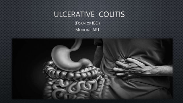 Ulcerative colitis (inflammatory Bowel Disease) | PPT