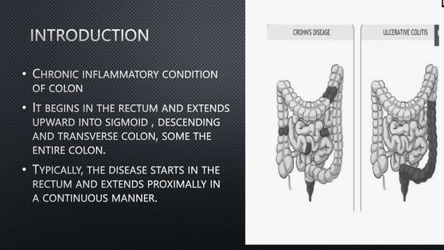 Ulcerative colitis (inflammatory Bowel Disease) | PPT
