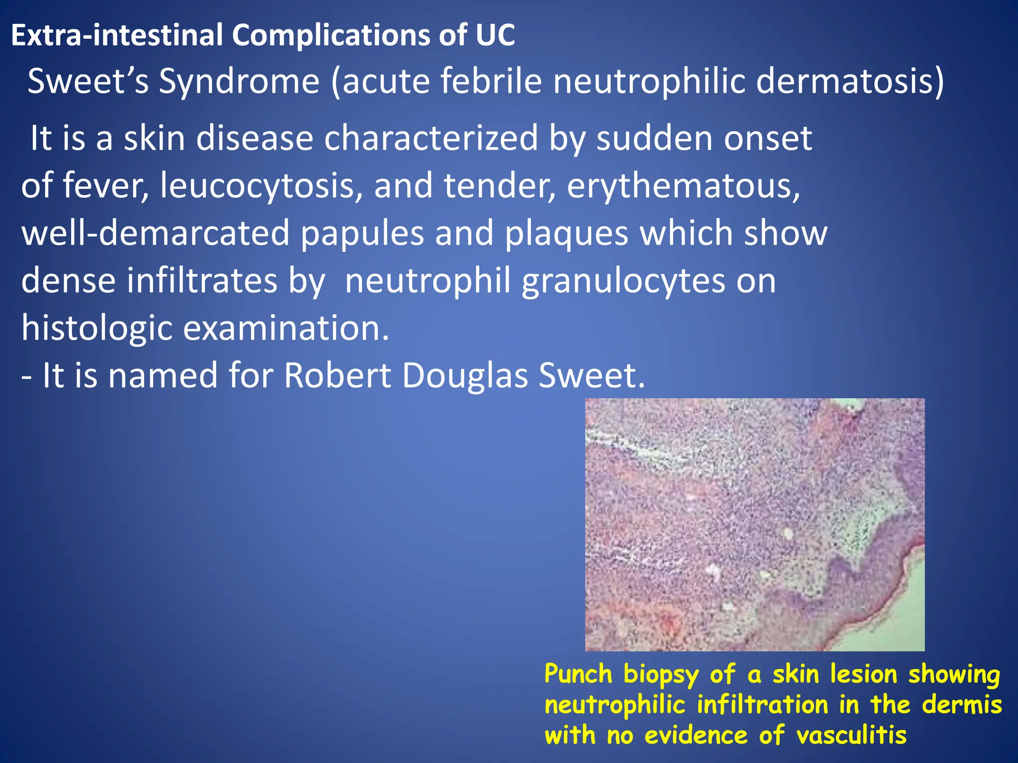 Ulcerative colitis explanation, management and therapy | PPT
