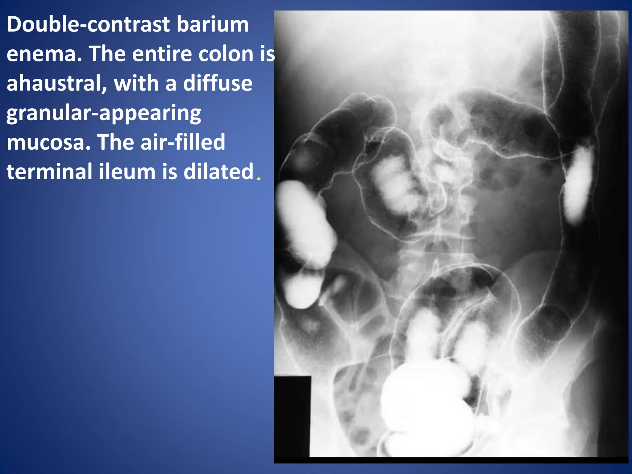 Ulcerative colitis explanation, management and therapy | PPT