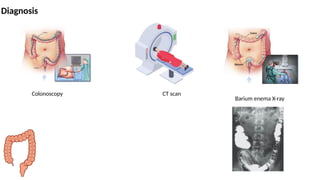 Ulcerative Colitis.It's pathophysiology,symptoms&Management | PPT