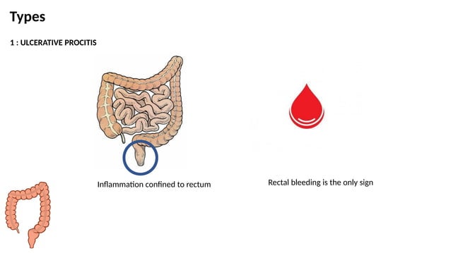Ulcerative Colitis.It's pathophysiology,symptoms&Management | PPT