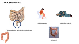 Ulcerative Colitis.It's pathophysiology,symptoms&Management | PPT