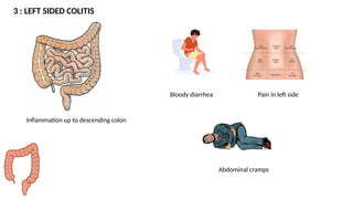 Ulcerative Colitis.It's pathophysiology,symptoms&Management | PPT