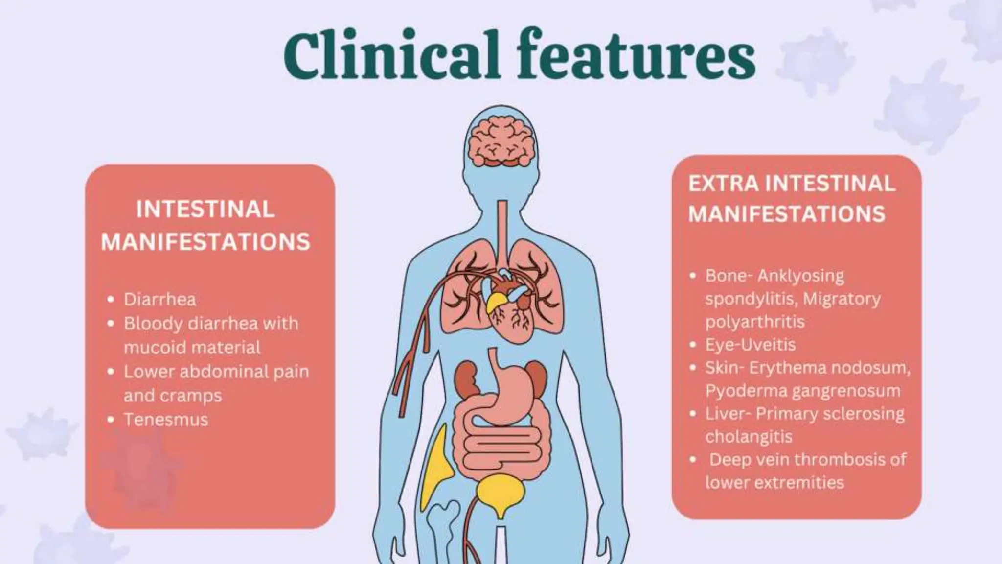 Inflammatory Bowel Disease - ULCERATIVE COLITIS | PPT