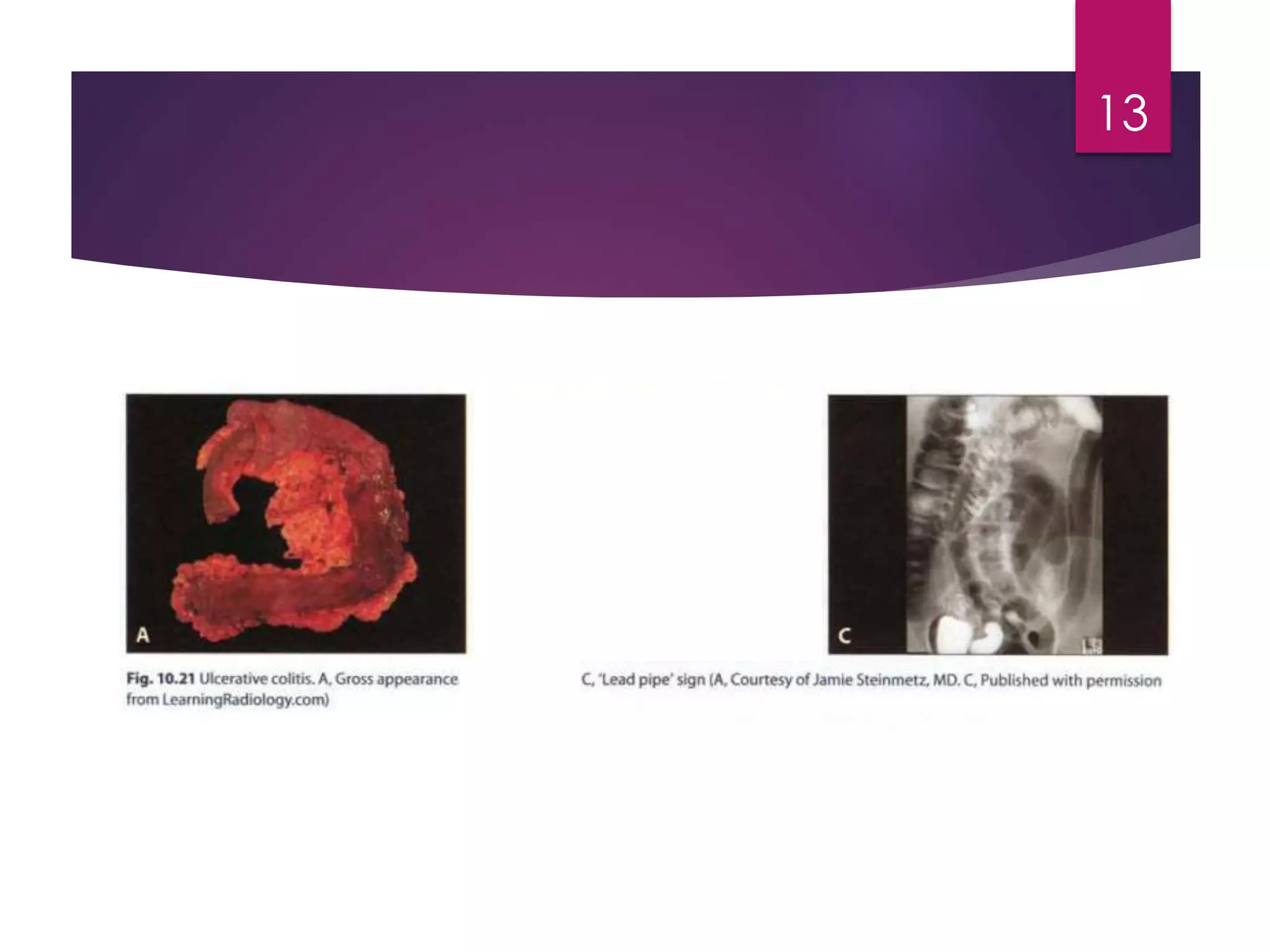 inflammatory bowel disease (Ulcerative colitis , crohn's disease) | PPTX