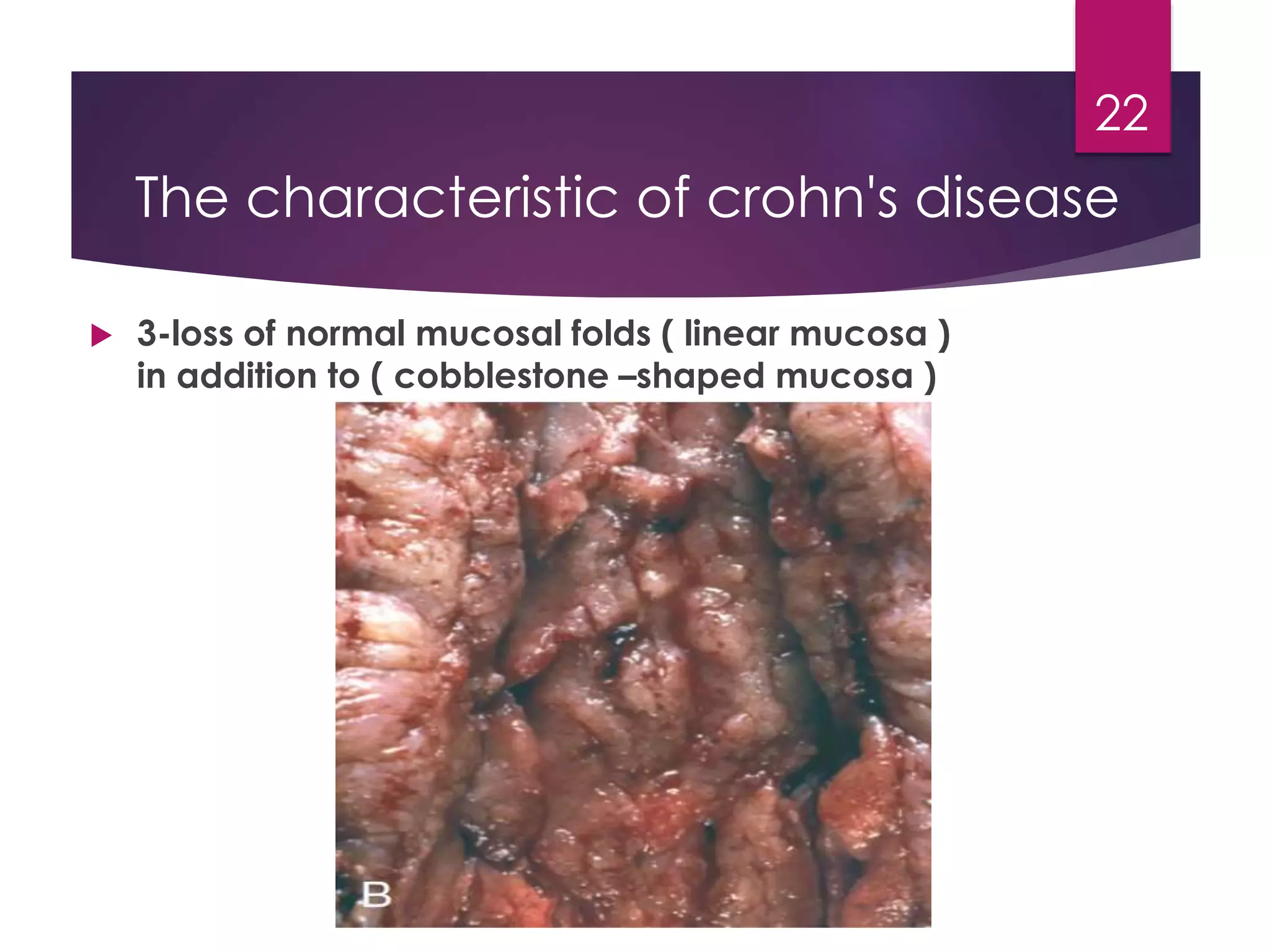 inflammatory bowel disease (Ulcerative colitis , crohn's disease) | PPTX