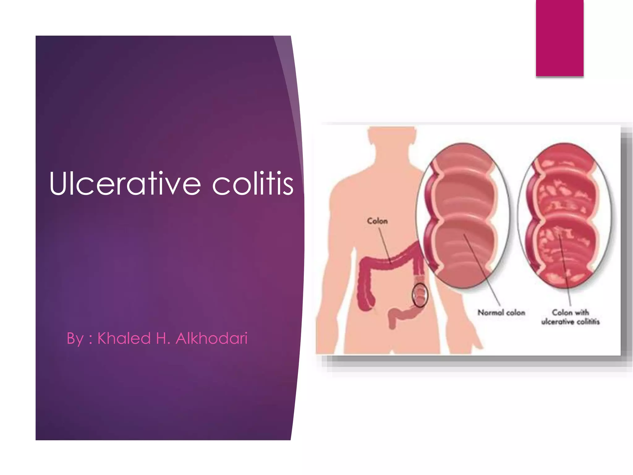 inflammatory bowel disease (Ulcerative colitis , crohn's disease) | PPTX