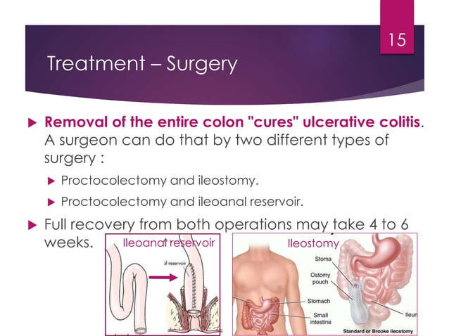 inflammatory bowel disease (Ulcerative colitis , crohn's disease ...