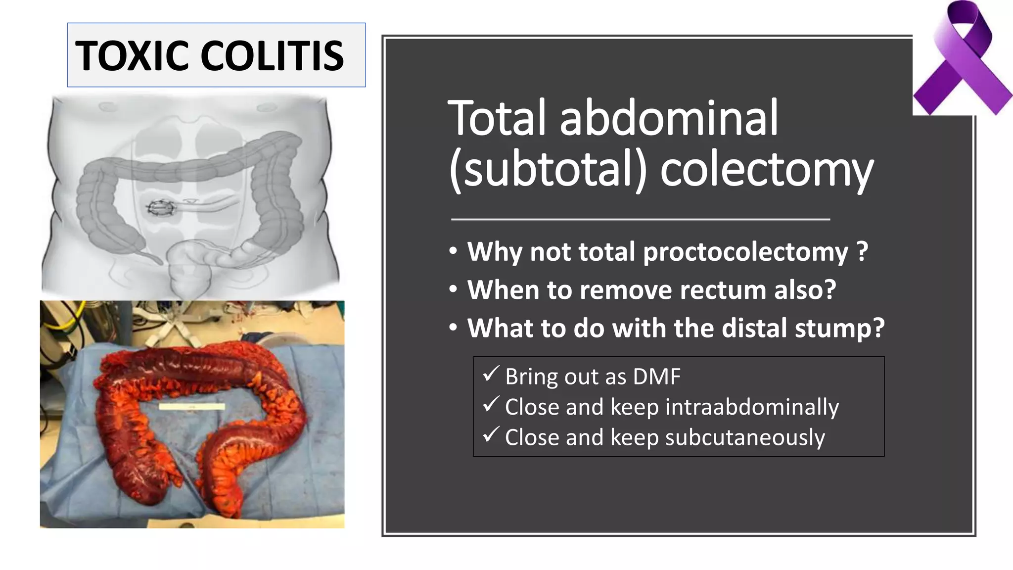 Ulcerative colitis complications management | PPTX