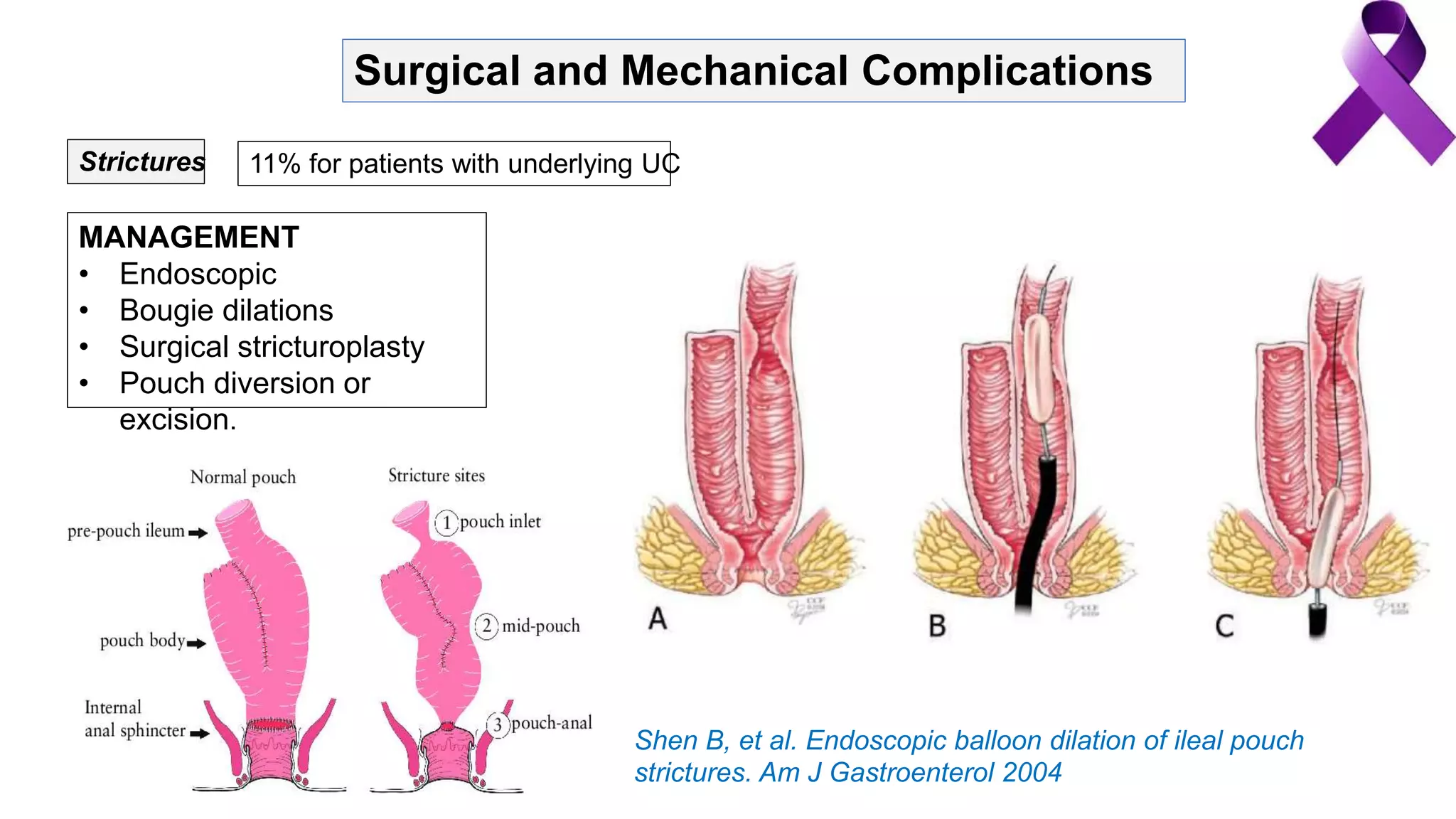 Ulcerative colitis complications management | PPTX