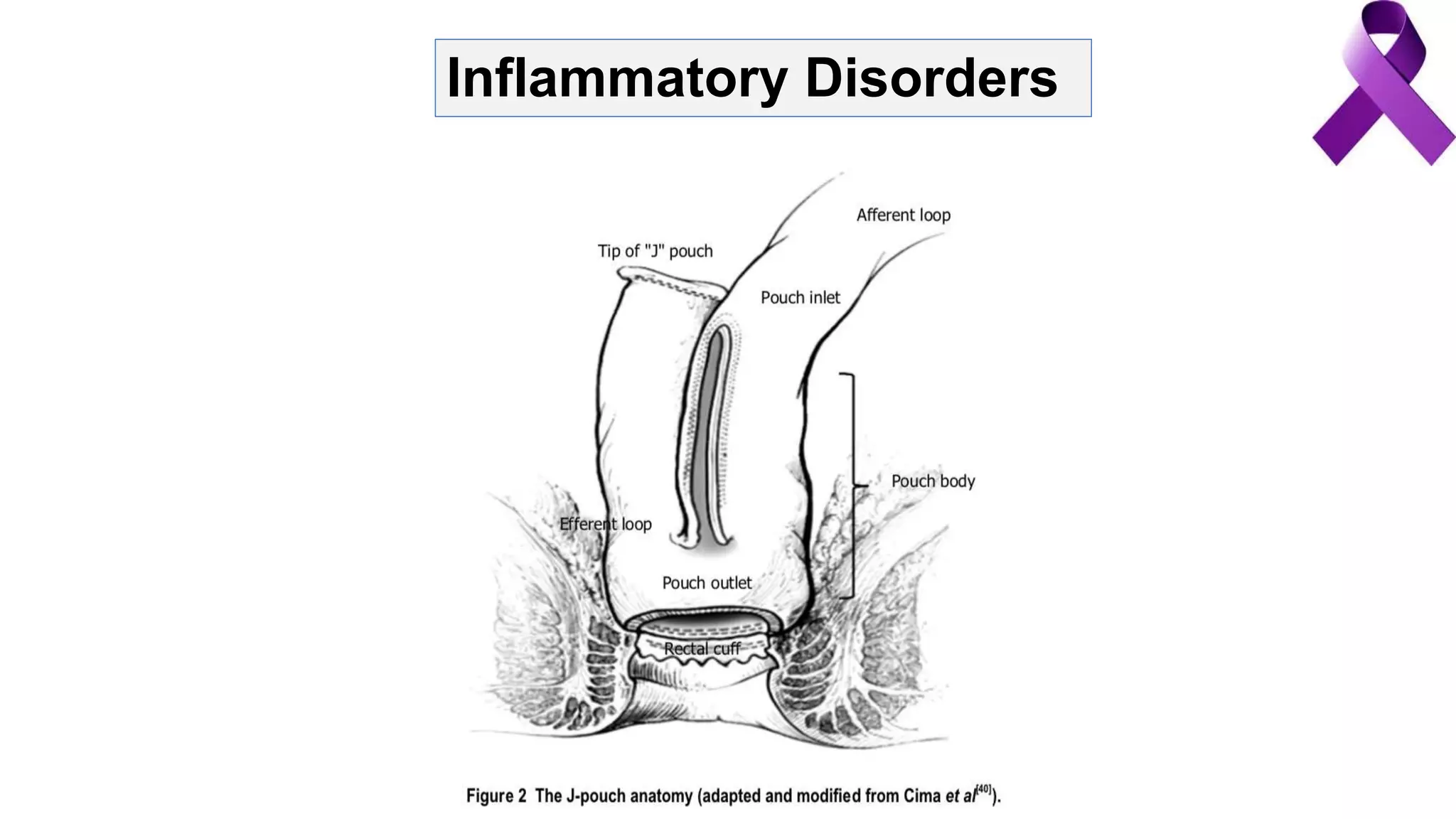 Ulcerative colitis complications management | PPTX