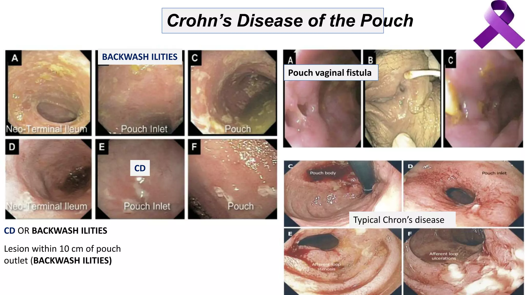 Ulcerative colitis complications management | PPTX